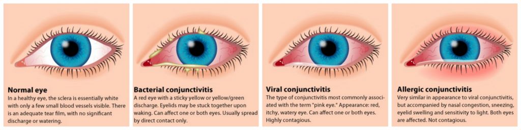 Conjunctivitis - The Pink Eye | VisionPlus Magazine