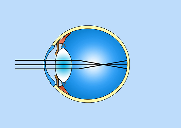 Refractive Surgery: Safe & Effective | VisionPlus Magazine