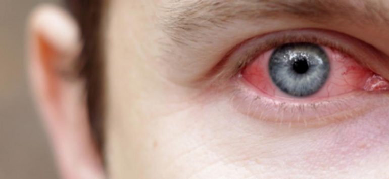 Be Aware Of Uveitis! | VisionPlus Magazine