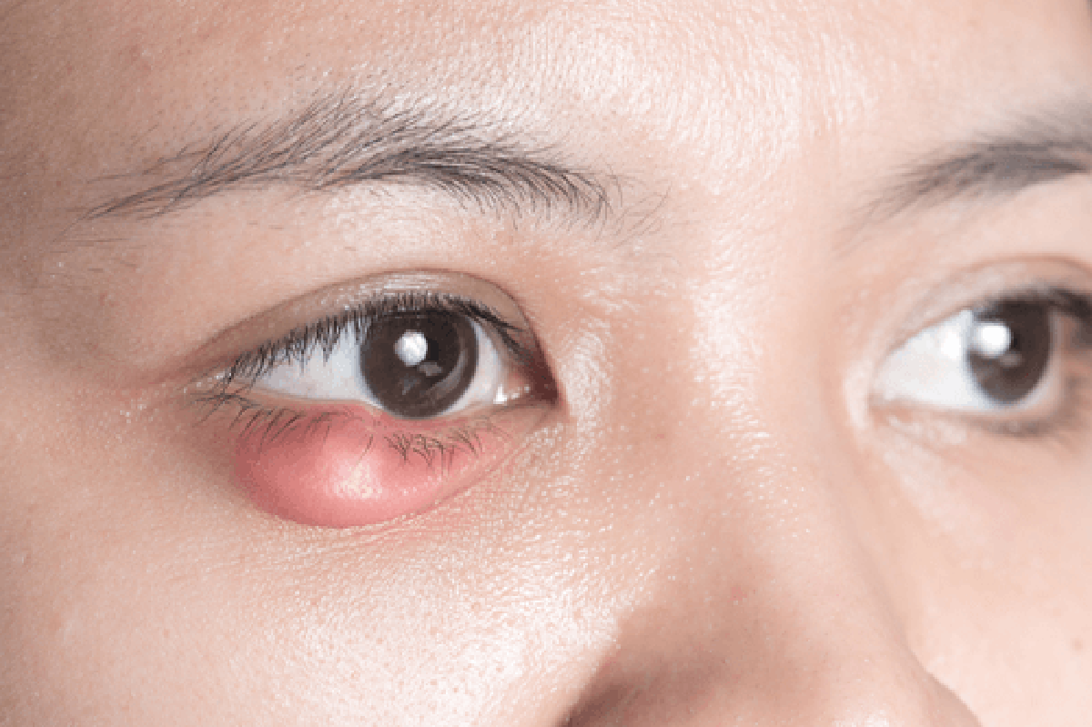 What Your Eye Symptoms May Mean | VisionPlus Magazine