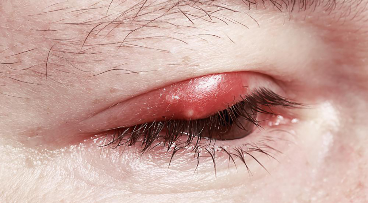 What Your Eye Symptoms May Mean | VisionPlus Magazine