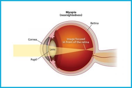 Myopia : An Introduction | VisionPlus Magazine