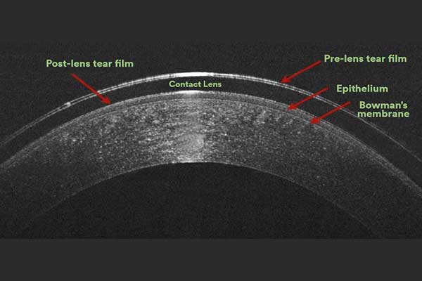 Assessment Of The Tear Film Part 1 | VisionPlus Magazine