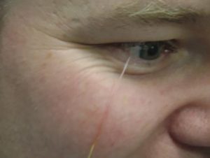 Assessment Of The Tear Film Part 2 | VisionPlus Magazine